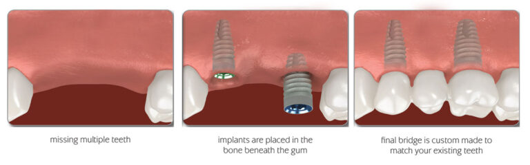 Multiple Implants - Sedation and Implant Dentists