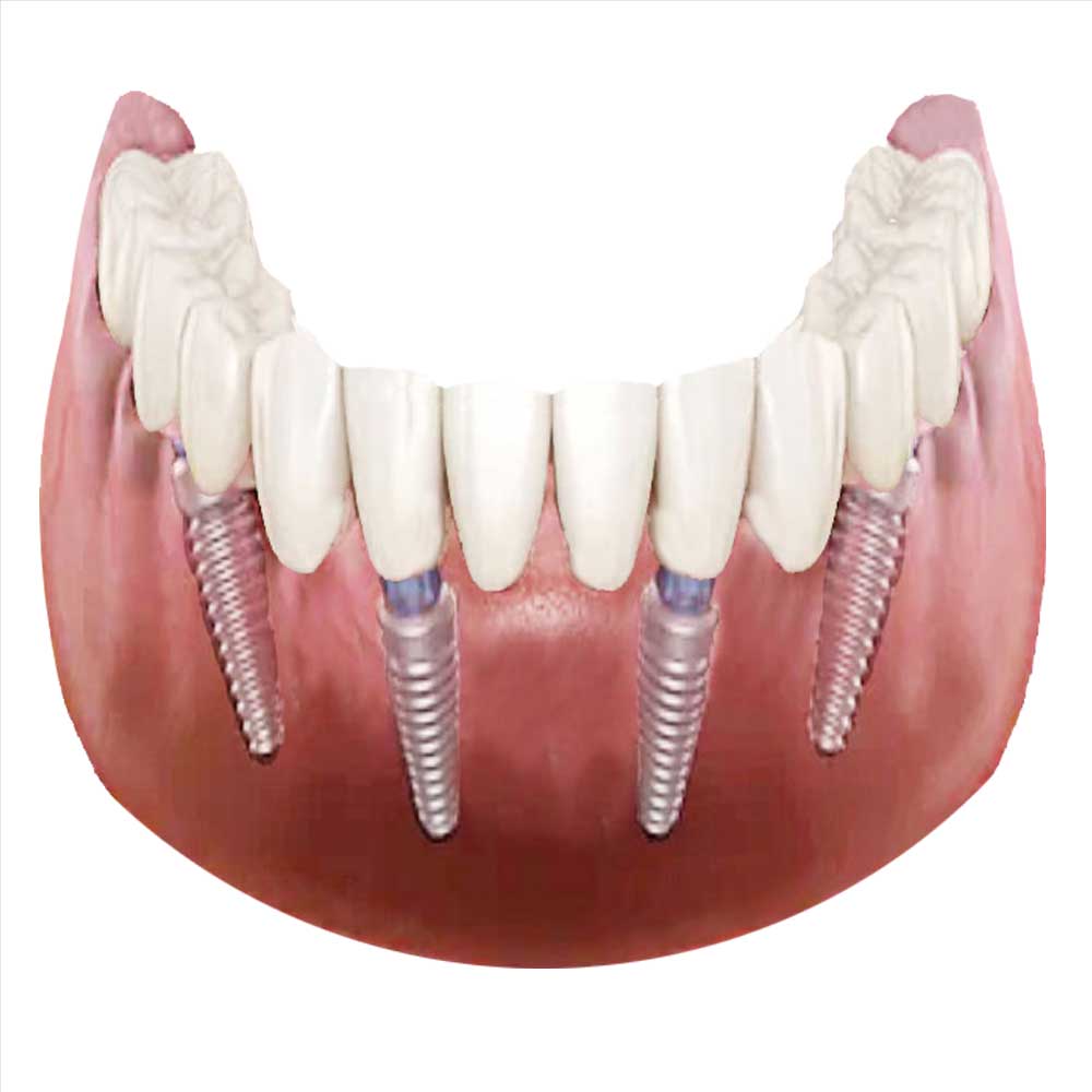 Multiple Implants - Sedation and Implant Dentists