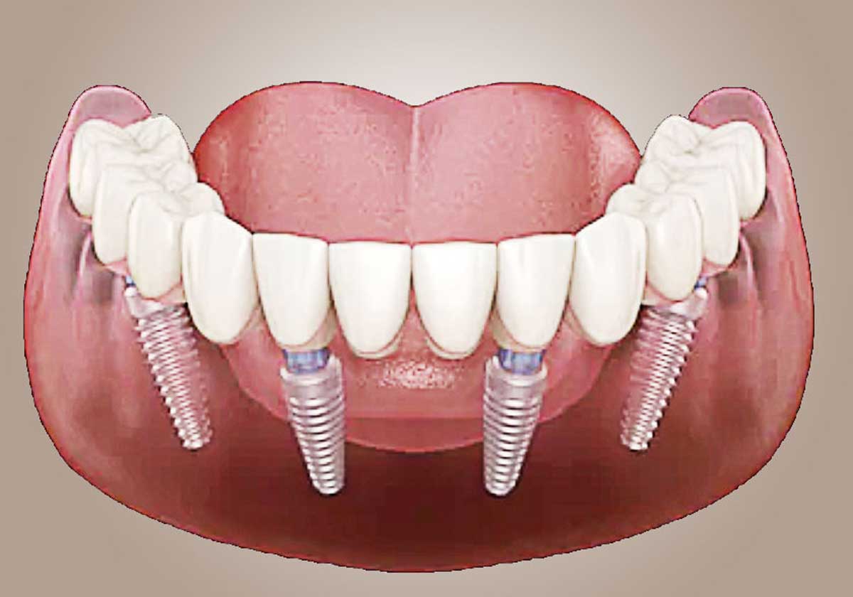 Multiple Implants - Sedation and Implant Dentists