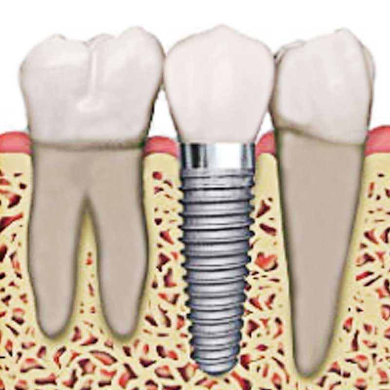 Single Dental Implant - Sedation and Implant Dentists