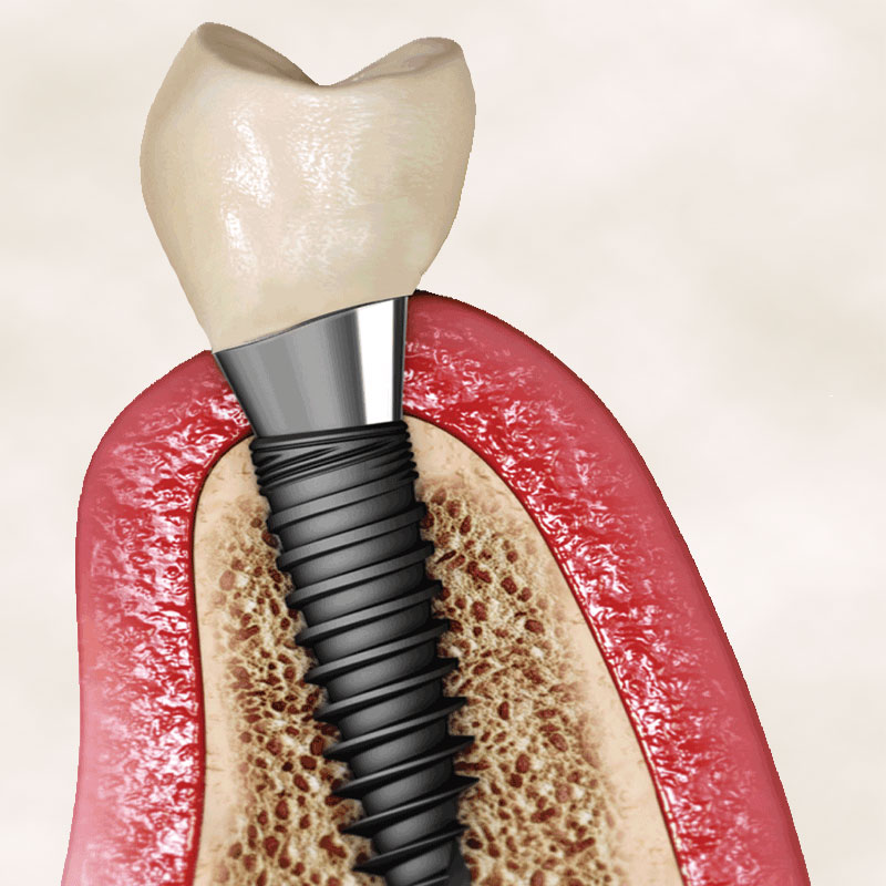 Single Implant - Sedation and Implant Dentists