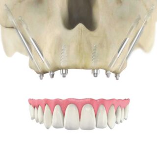 Zygomatic Implants - Sedation and Implant Dentists