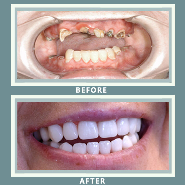 Dental Implant Evaluation Los Angeles - Sedation and Implant Dentists