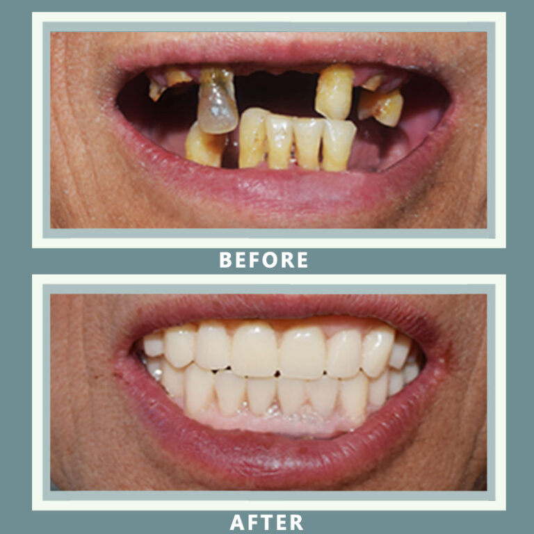 Free Dental Implant Evaluation - Mobile - Sedation and Implant Dentists