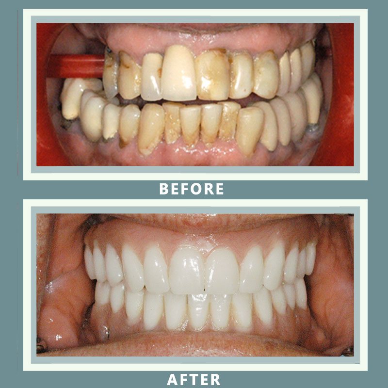 Bad Teeth Before And After Bad Teeth Before And After