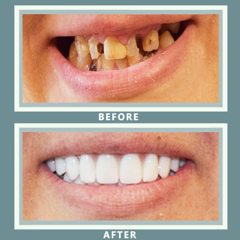 Free Dental Implant Evaluation - Mobile - Sedation and Implant Dentists