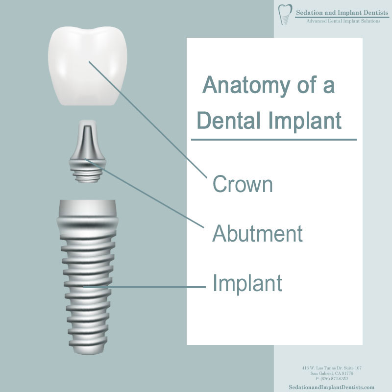 What exactly are dental implants? - Sedation and Implant Dentists