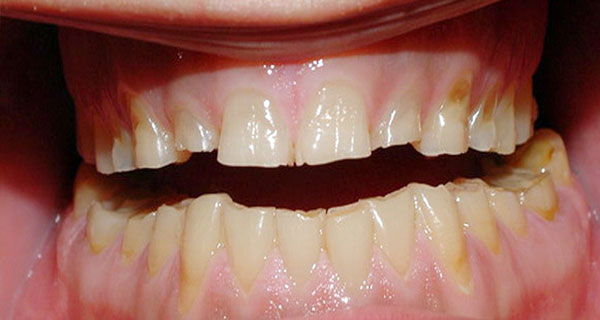 Common Causes of Tooth Wear - Sedation and Implant Dentists