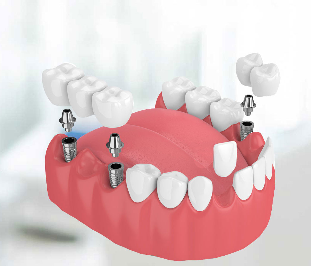 Multiple Dental Implants - Sedation and Implant Dentists