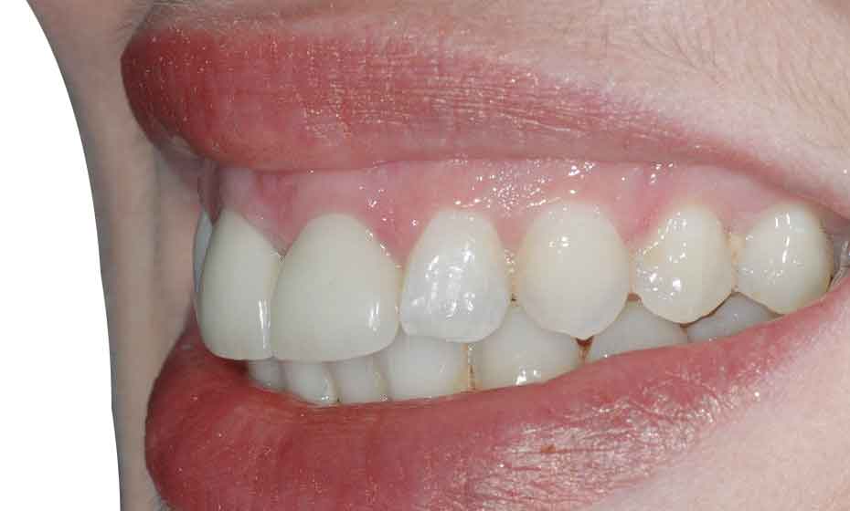 What is cosmetic gum surgery? - Sedation and Implant Dentists