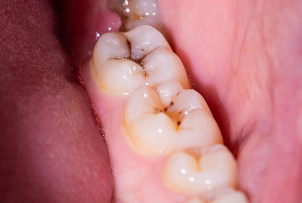 Why am I getting cavities all of a sudden? - Sedation and Implant Dentists